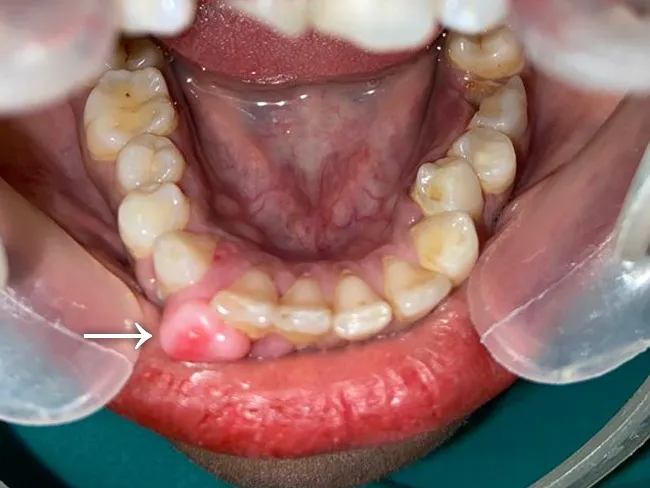 Peripheral Ossifying Fibroma : Clinical Features