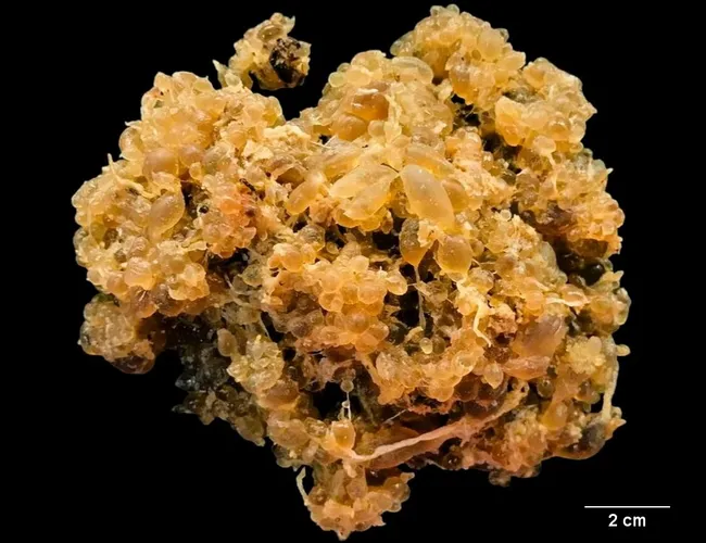 Complete Hydatidiform Mole