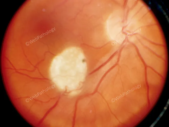 Astrocytic Hamartoma : Tuberous Sclerosis