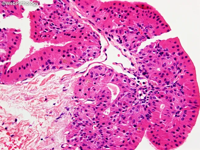 Oncocytoma of Caruncle