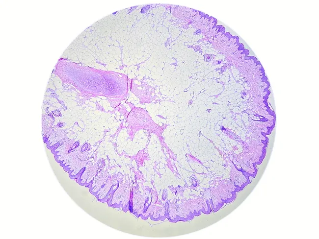 Nevus Lipomatosus Superficialis