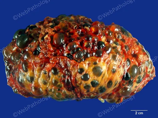 Autosomal Dominant Polycystic Kidney: Macroscopic Features