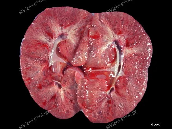 arpkd kidney