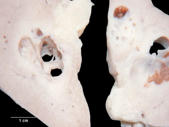 Medullary Sponge Kidney: Macroscopic Features
