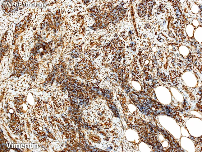 Desmoplastic Small Round Cell Tumor: Vimentin
