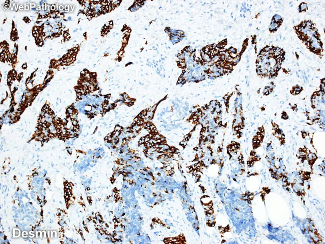 Desmoplastic Small Round Cell Tumor: Desmin