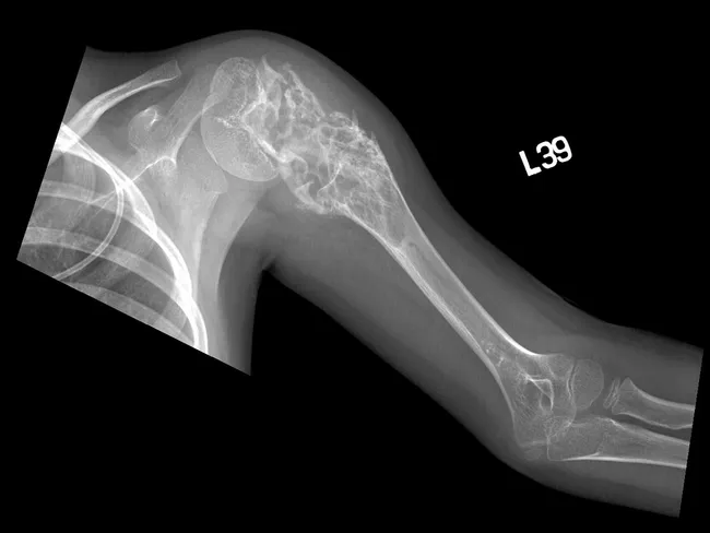 ewing sarcoma arm