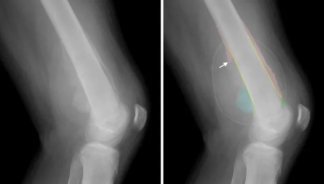 ewing sarcoma mri knee