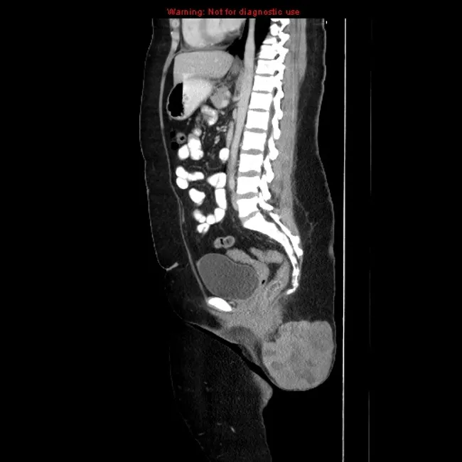 ewing sarcoma mri scan