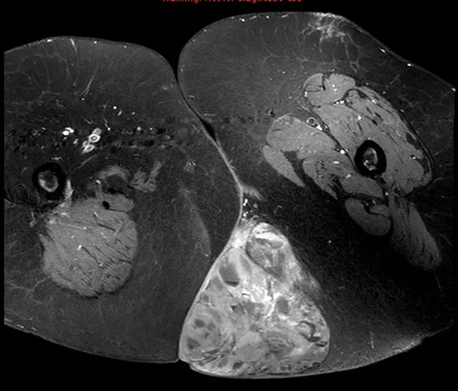 Ewing Sarcoma: Imaging