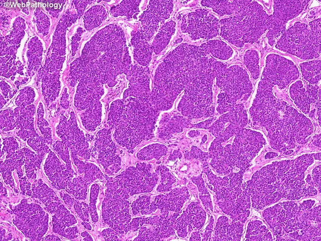 Ewing Sarcoma: Microscopic