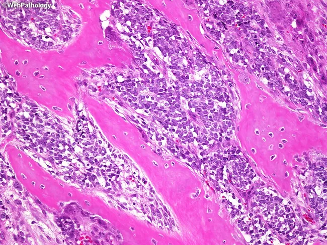 Ewing Sarcoma: Microscopic