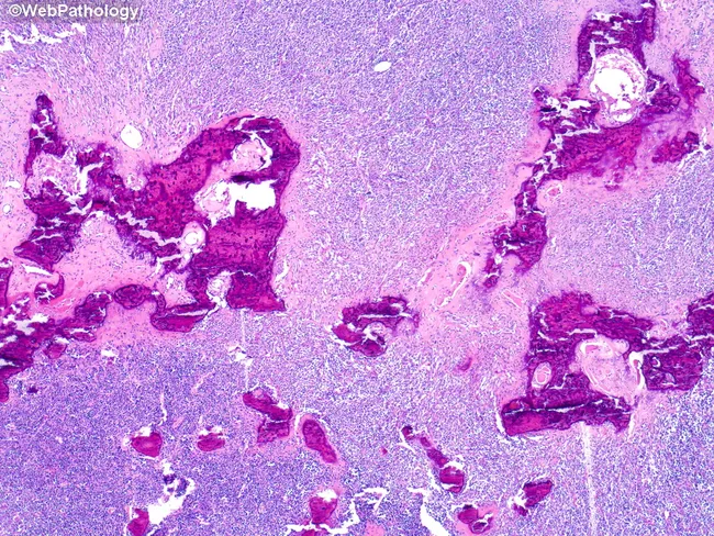 Ewing Sarcoma: Microscopic