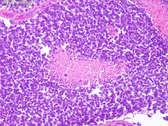 Ewing Sarcoma: Microscopic