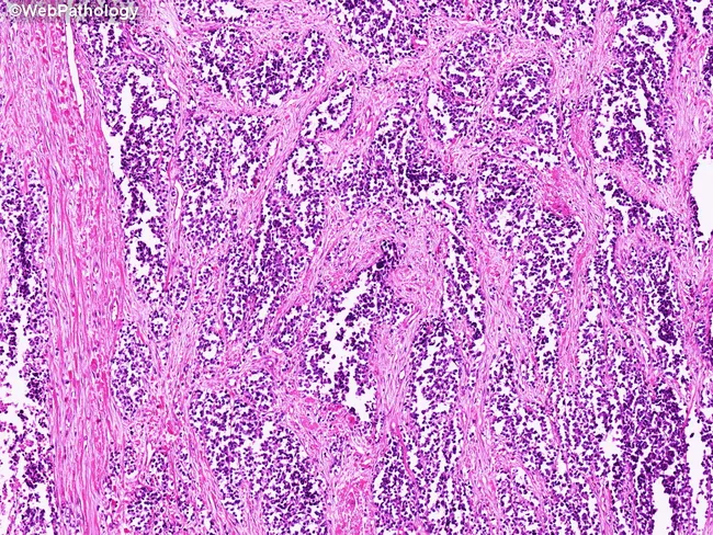 Ewing Sarcoma: Microscopic