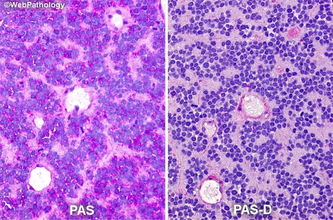 ewing sarcoma pathology outlines