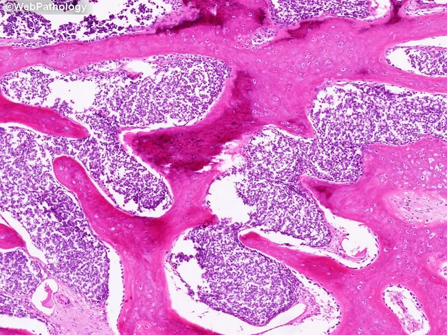 ewing sarcoma solid tumor