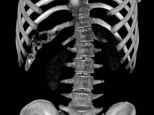 Ewing Sarcoma Imaging
