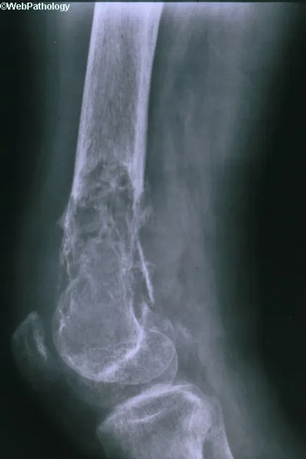 Fibrosarcoma