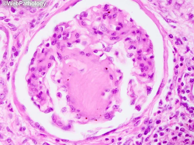 Diabetic Nephropathy: Nodular Glomerulosclerosis