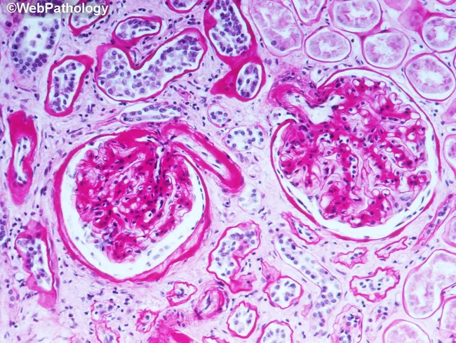 Diabetic Nephropathy: PAS Stain