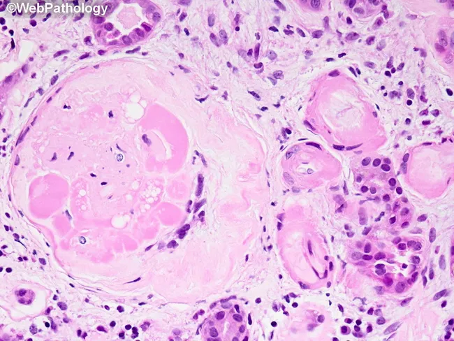 Diabetic Nephropathy: Hyaline Deposits