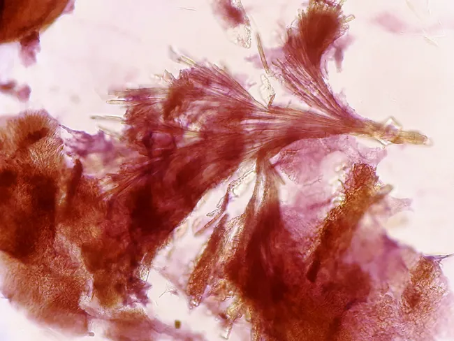 gout under a microscope