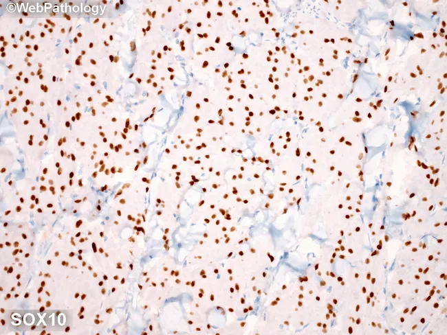 Granular Cell Tumor : SOX10