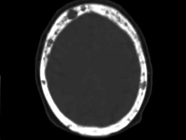 Plasma Cell Myeloma: Imaging