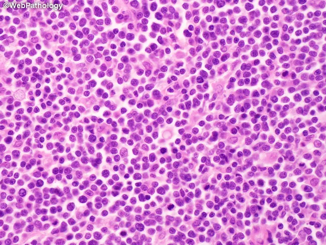 Mediastinal T-Lymphoblastic Leukemia/Lymphoma: Microscopic
