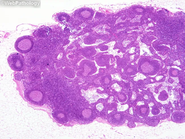 Normal Lymph Node