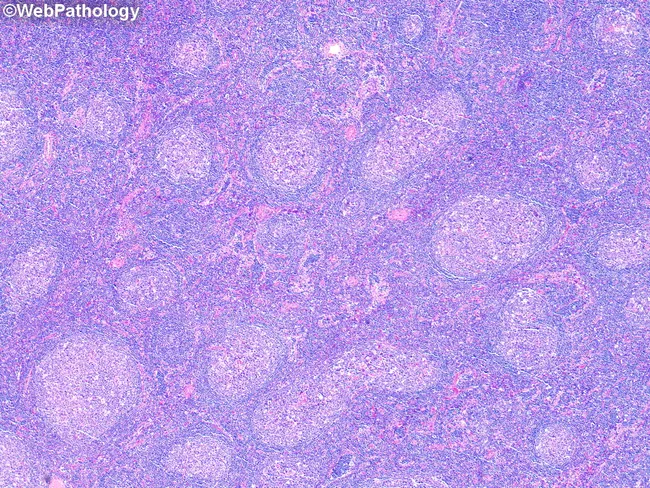 Reactive Lymph Node