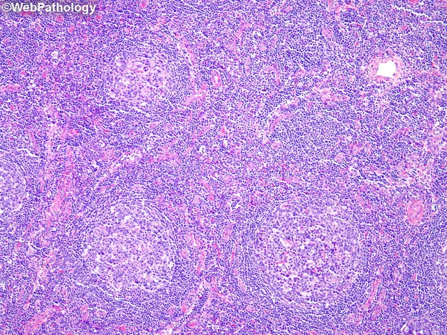 Reactive Lymph Node