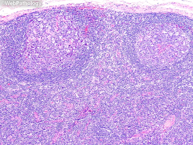 Reactive Lymph Node