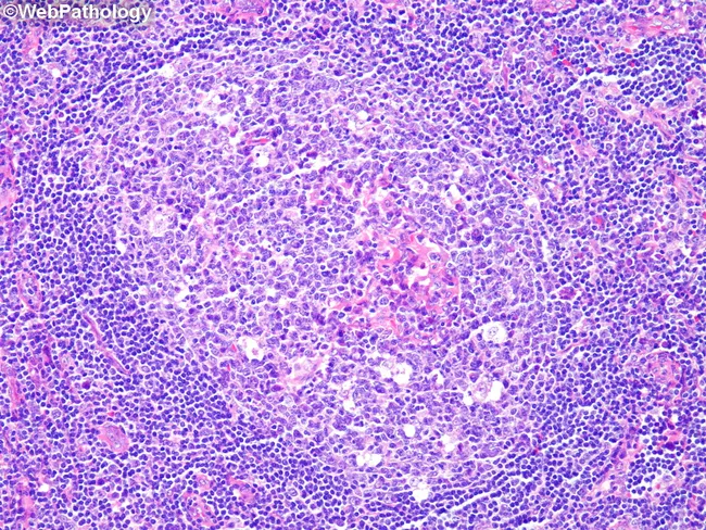 Reactive Lymph Node