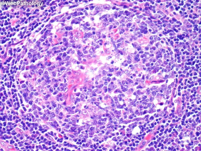 Reactive Lymph Node