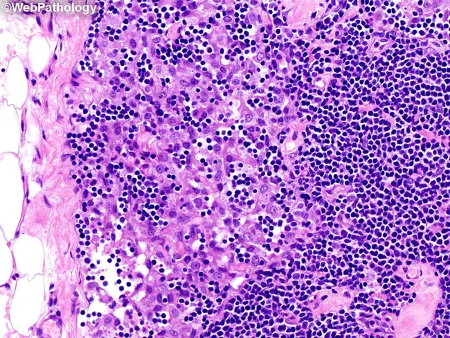 Reactive Lymph Node