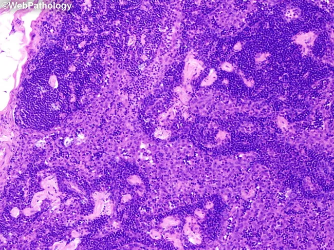 Reactive Lymph Node