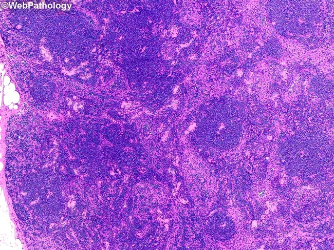 Reactive Lymph Node