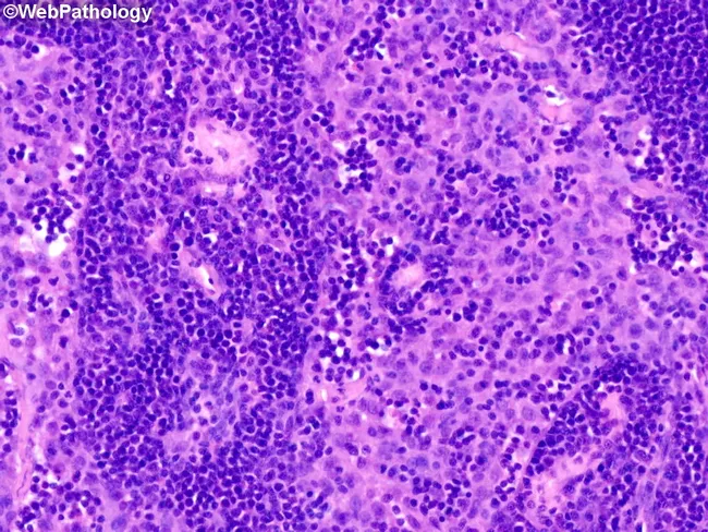 Reactive Lymph Node