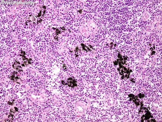 Normal Lymph Node: Anthracosis