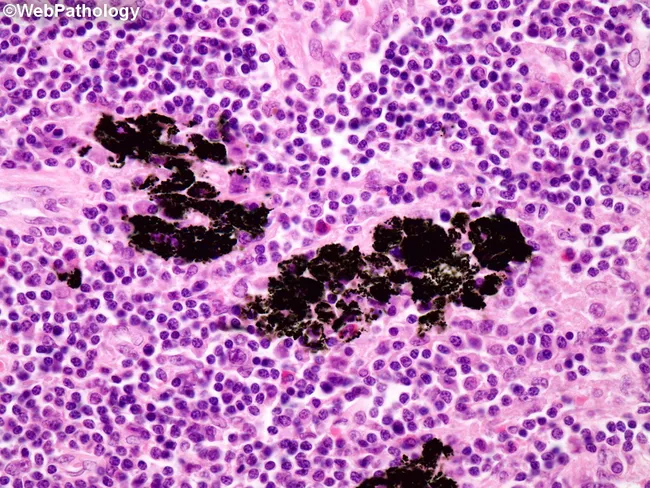 Normal Lymph Node: Anthracosis