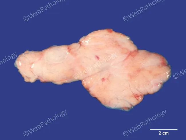 Normal Thymus