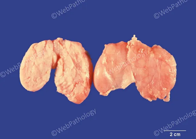 Normal Thymus