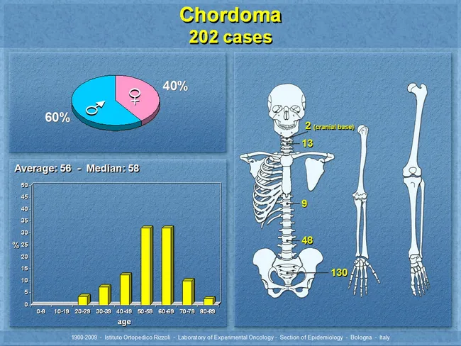 Chordoma: Introduction