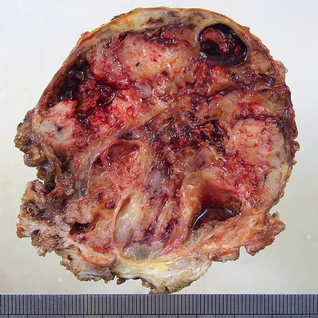 Chordoma: Clinical Features