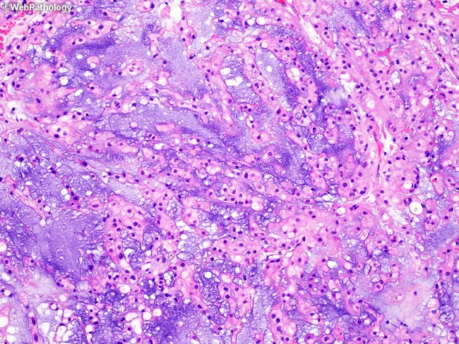 Chordoma: Microscopic Features