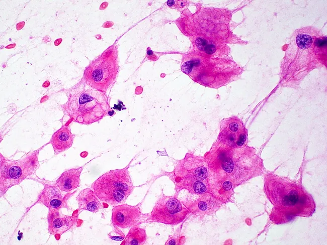 Chordoma: Cytology