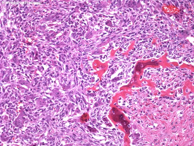 Giant Cell Tumor of Bone: Reactive Bone Formation