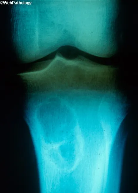Non-Ossifying Fibroma (Metaphyseal Fibrous Defect)